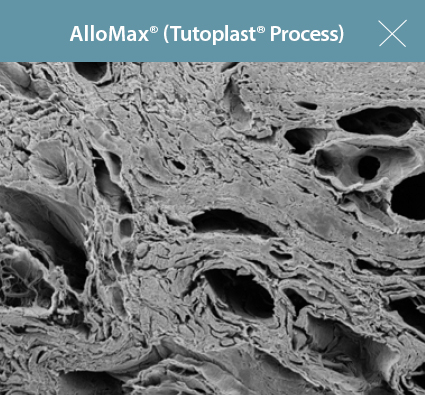 AlloDerm™ RTM Product Performance