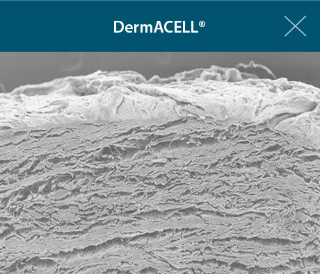 AlloDerm™ RTM Product Performance