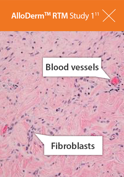 AlloDerm™ RTM Product Performance