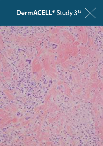 AlloDerm™ RTM Product Performance