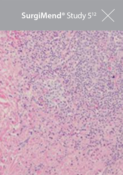 AlloDerm™ RTM Product Performance