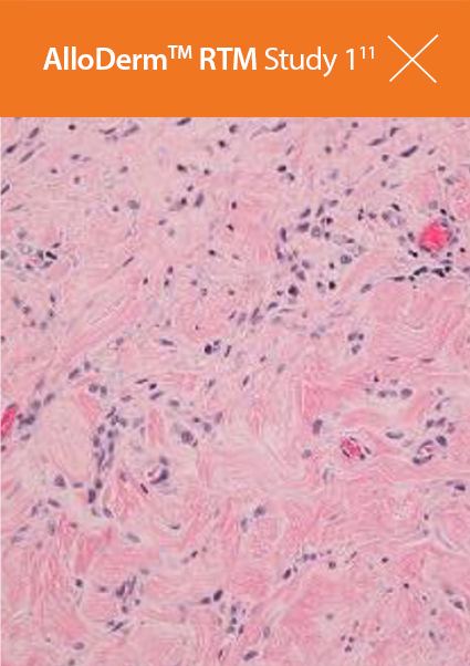 AlloDerm™ RTM Product Performance