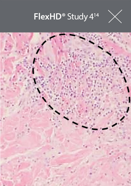 AlloDerm™ RTM Product Performance