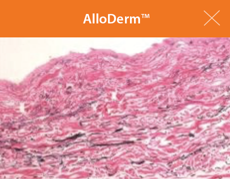 AlloDerm™ RTM Product Performance